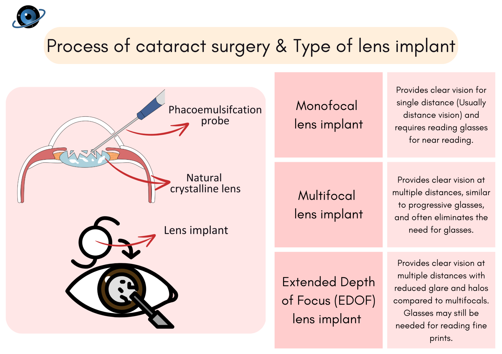 Understanding Cataracts: Causes, Symptoms, and Treatment Options ...