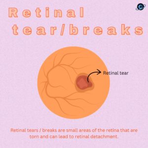 Retinal Tear & Detachment – Symptoms, Risk factors and Prevention ...